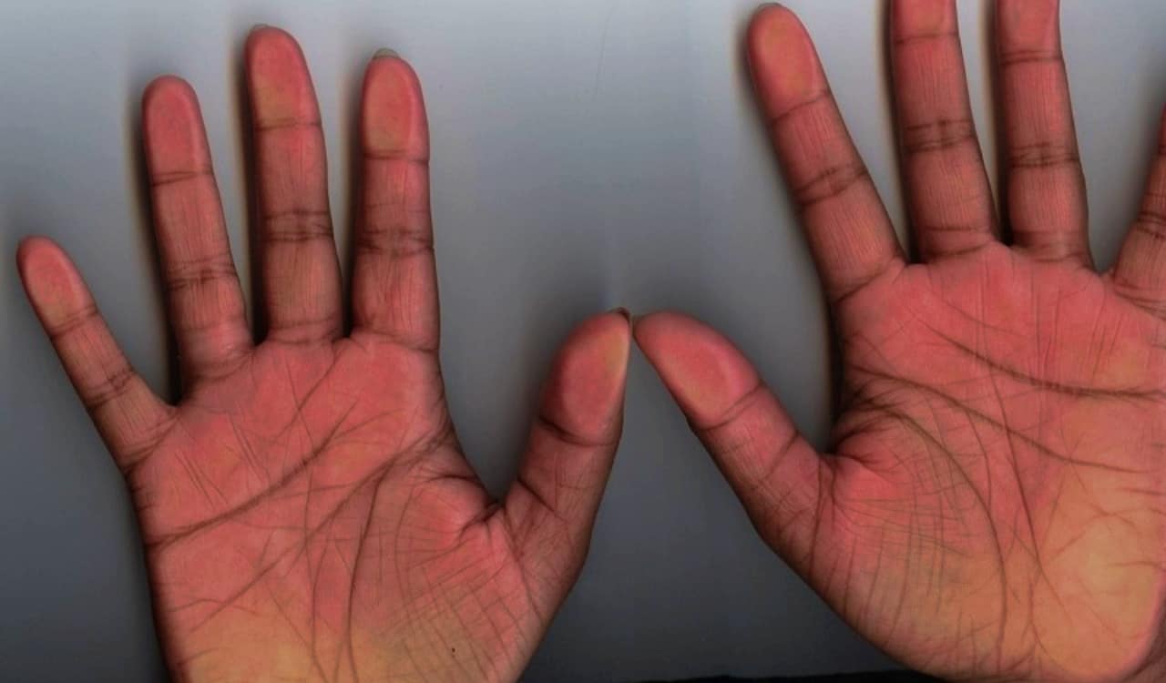 Rare Genetic Traits Most People Probably Do Not Have